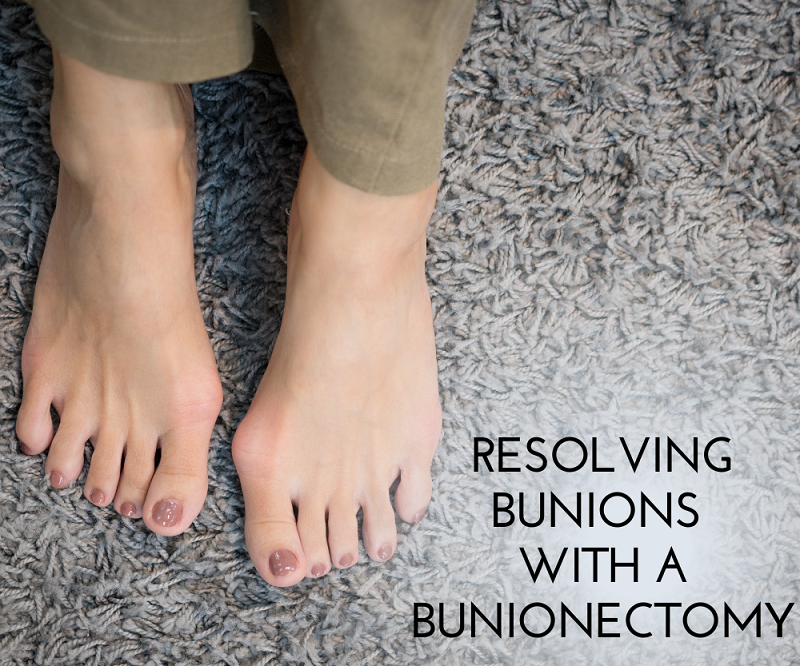 Resolving Bunions With A Bunionectomy | Starrett Podiatry